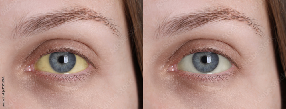 Collage with photos of woman before and after hepatitis treatment ...