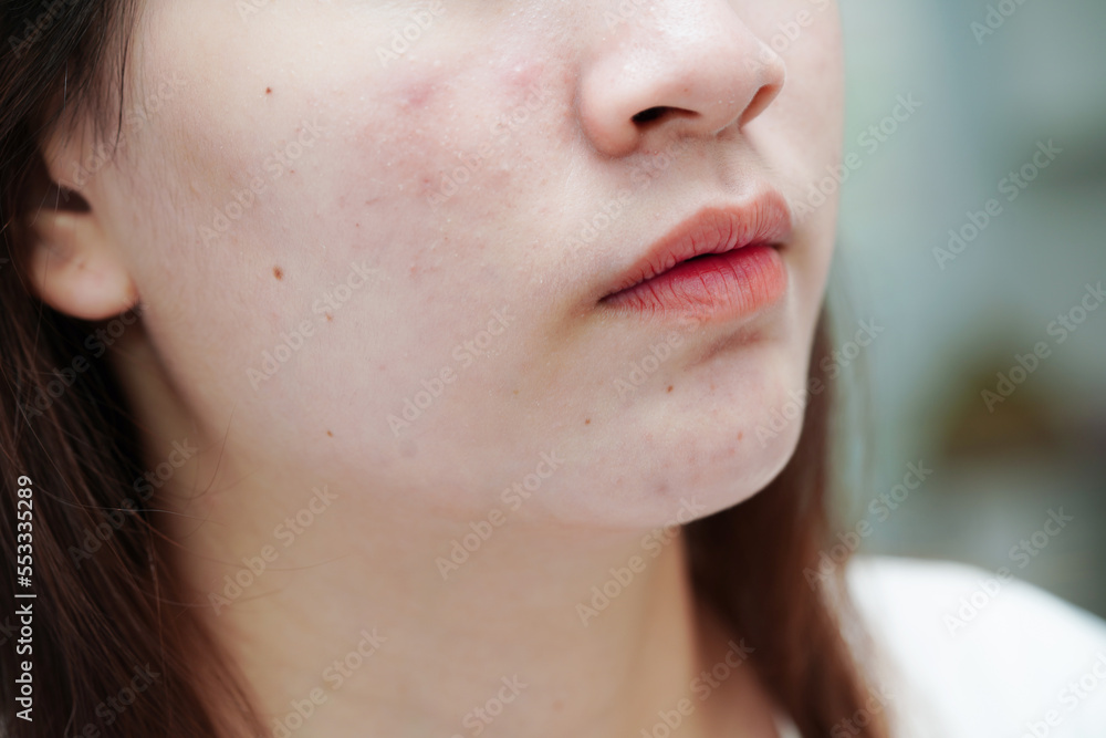 Acne pimple and scar on skin face, disorders of sebaceous glands ...