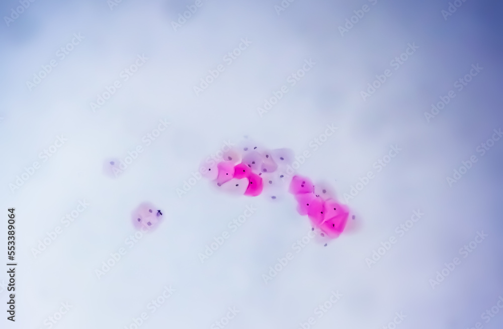 Foto de Paps smear under microscopy showing inflammatory smear with hpv ...