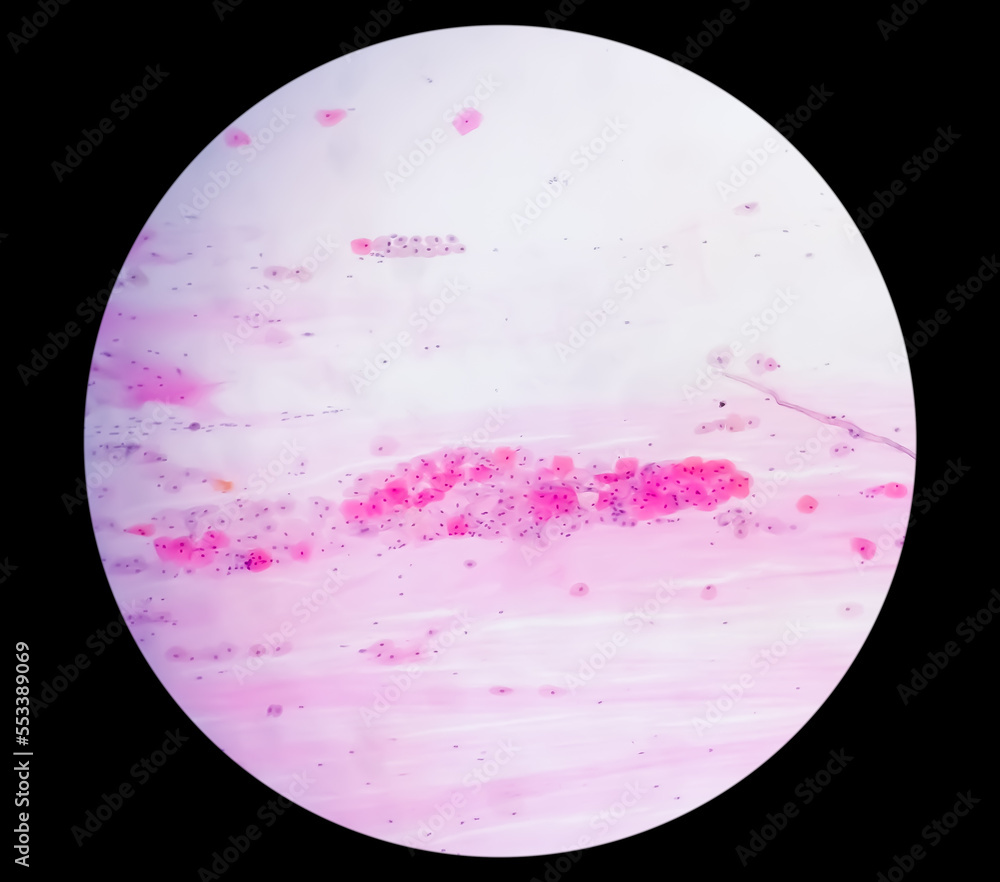 Paps smear under microscopy showing inflammatory smear with hpv related ...