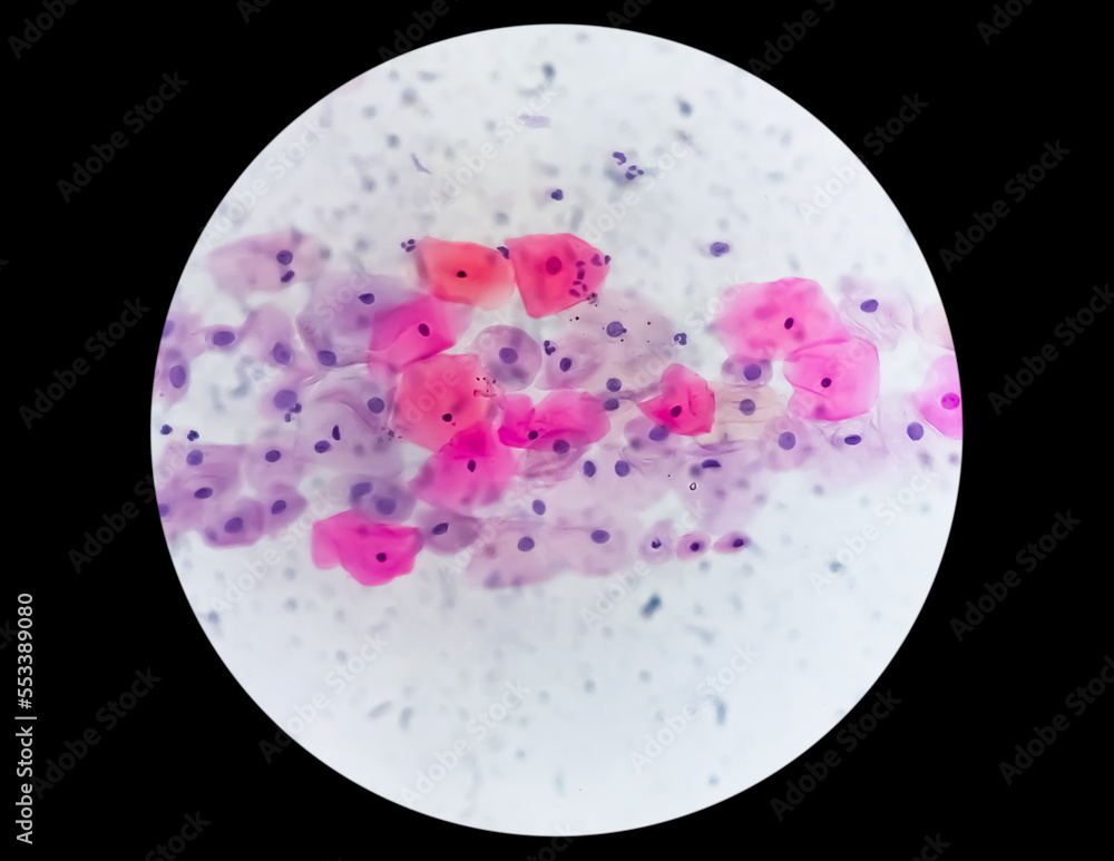 Paps smear under microscopy showing inflammatory smear with hpv related ...