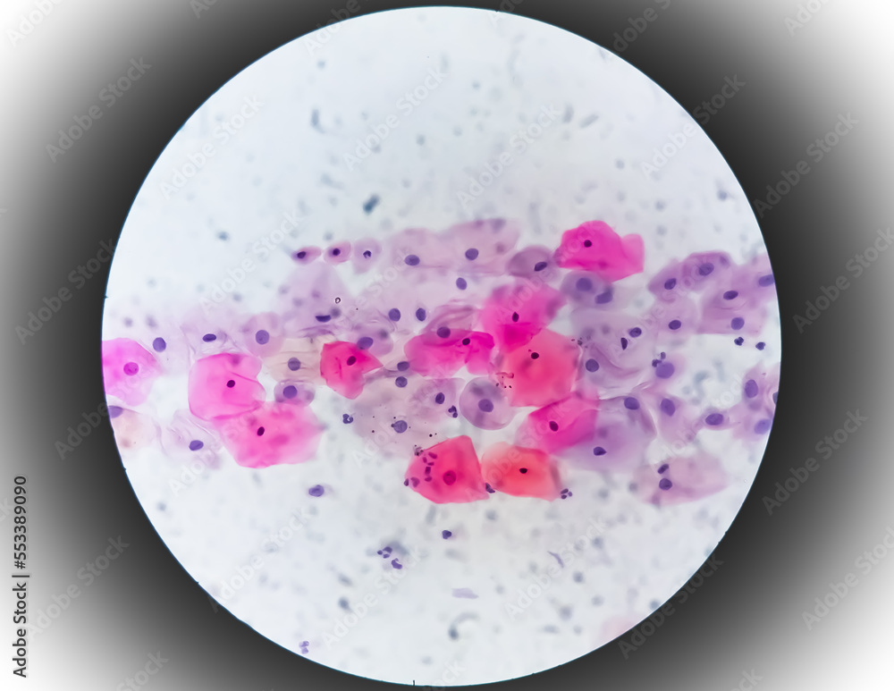 Paps smear under microscopy showing inflammatory smear with hpv related ...