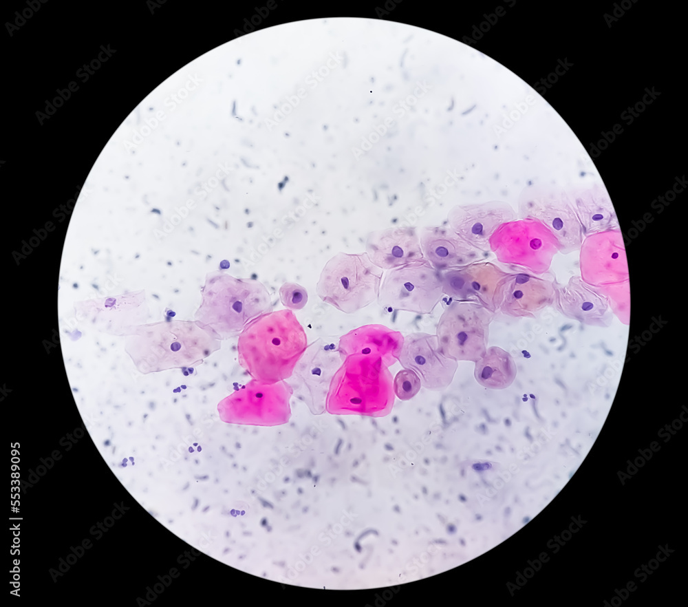 Paps smear under microscopy showing inflammatory smear with hpv related ...