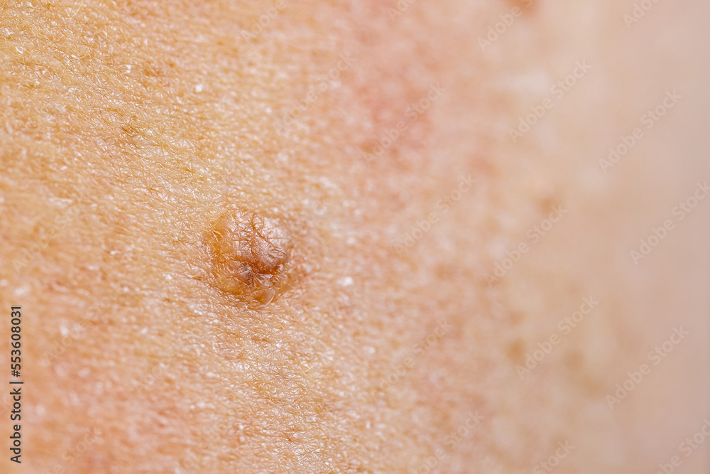 Oncology mole big wart on skin old woman. Concept dermatology body ...