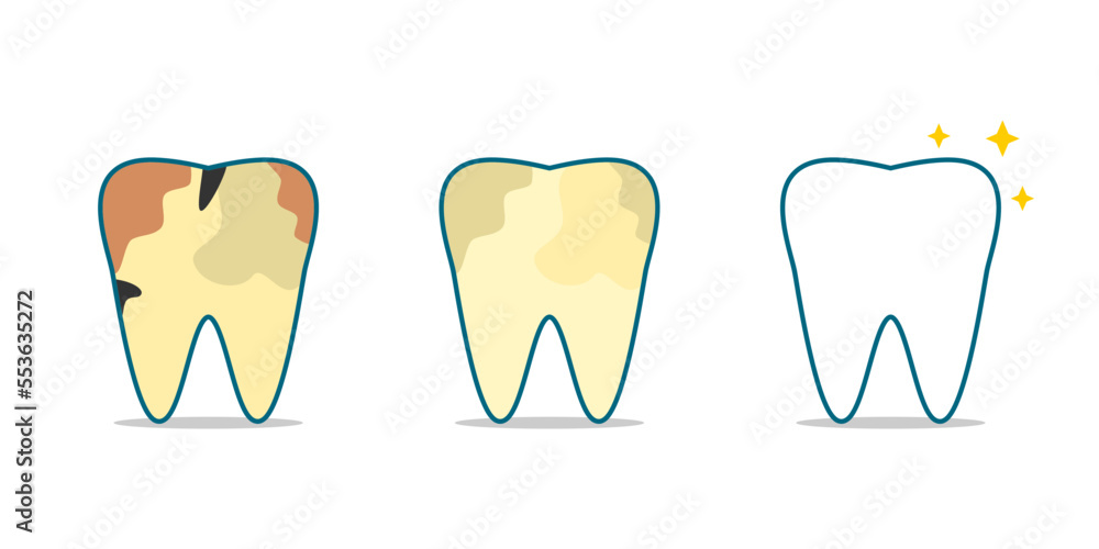 Set before after different tooth decay stains to white shiny clean ...
