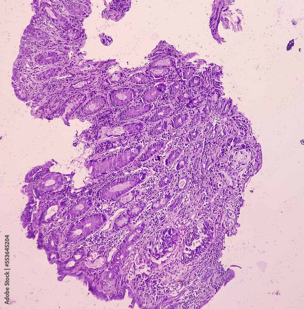 Transverse colon microscopic image seen atypical cell, colonic mucosa ...