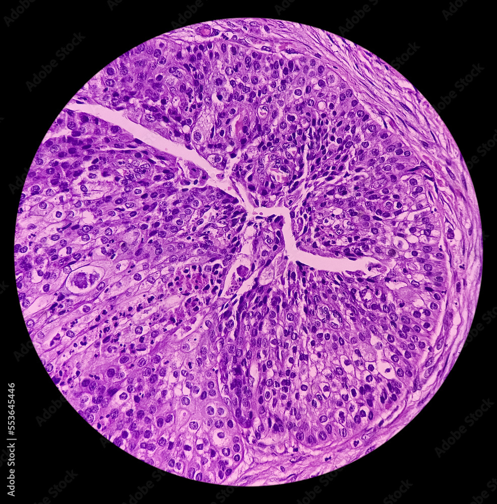 High Grade Mucoepidermoid Carcinoma Of Parotid Cyst Microscopic Show Parotid Tissue Features