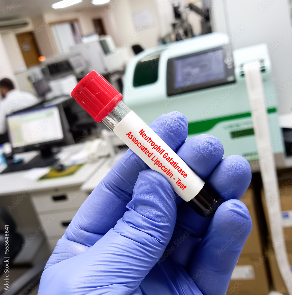 Blood sample for Neutrophil gelatinase-associated lipocalin(NGAL) test ...