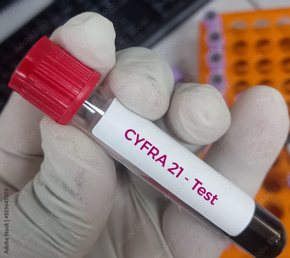 Blood sample for CYFRA-21 test, a sensitive and specific tumor marker ...