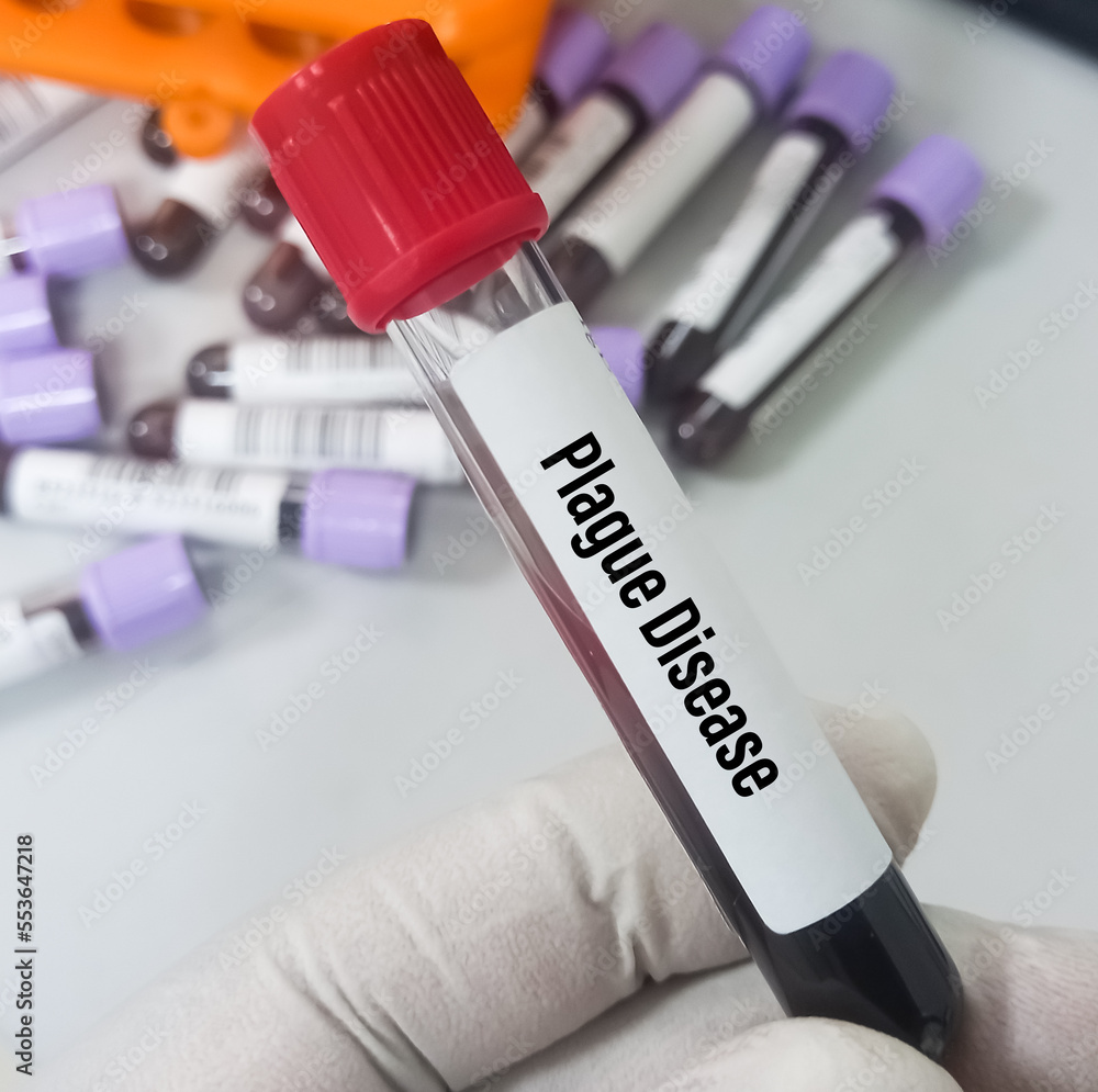 Blood sample for plague disease, an infectious disease caused by the ...