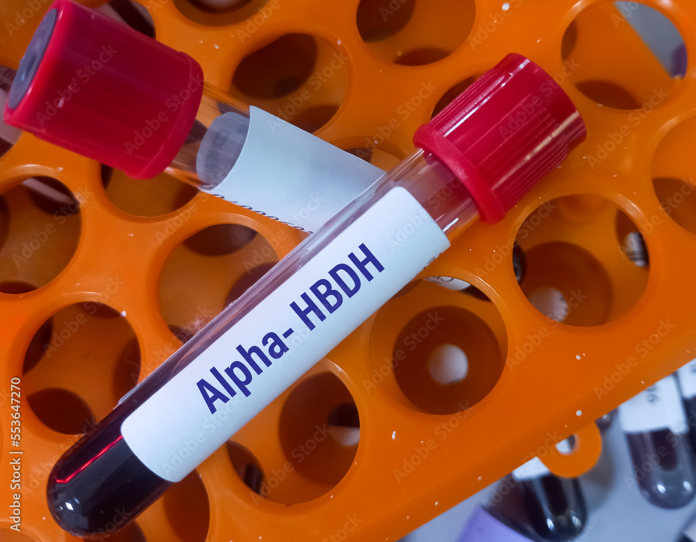 Blood sample for α-HBDH(α-Hydroxybutyrate dehydrogenase) test ...