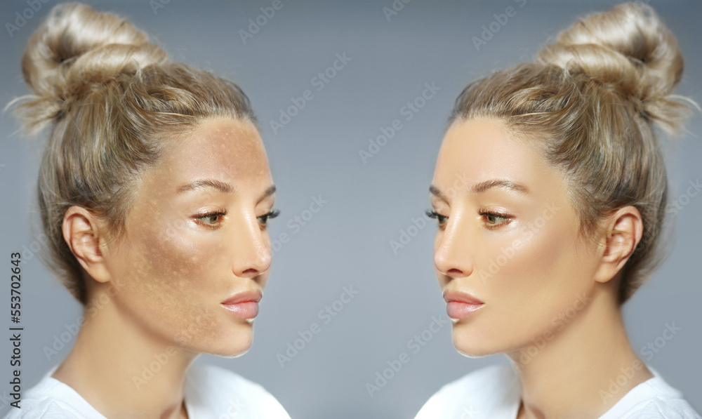 Dark spots, freckles,hyperpigmentation(melasma or chloasma),concept ...