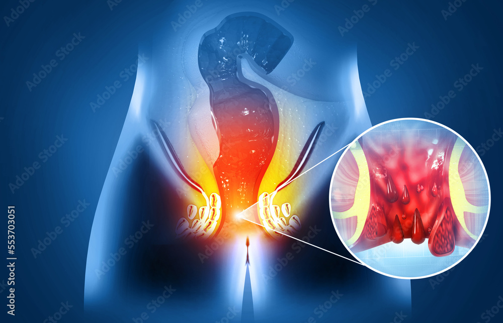 Haemorrhoids (piles) on scientific background. 3d illustration Stock Illustration | Adobe Stock