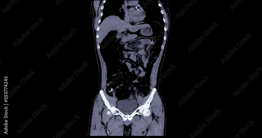 CT colonography Coronal view showing intra colon for screening ...