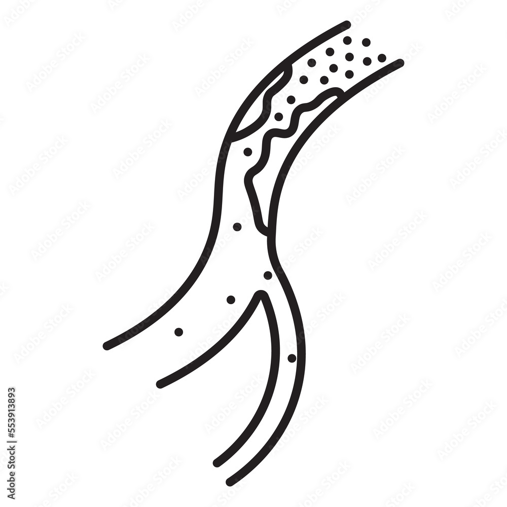 High cholesterol or atherosclerosis icon. Artery blocked by cholesterol ...