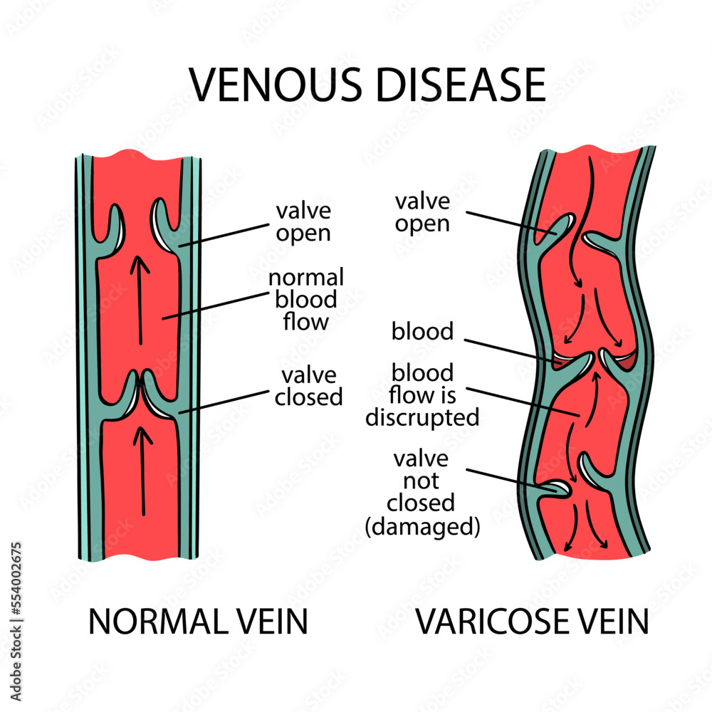 VENOUS DISEASE SCHEME Varicose Veins Of Human Legs Twisting And ...