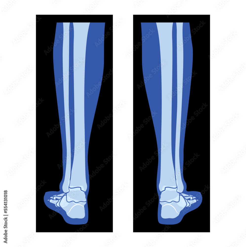 X-Ray Foot Legs Skeleton, Fibula, Tibia - Phalanges Human body, Bones ...