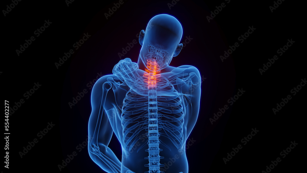 3D medical illustration of a man having neck pain Stock Illustration ...