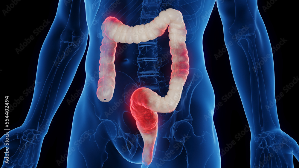 3D medical illustration of a man's inflamed colon Stock Illustration ...