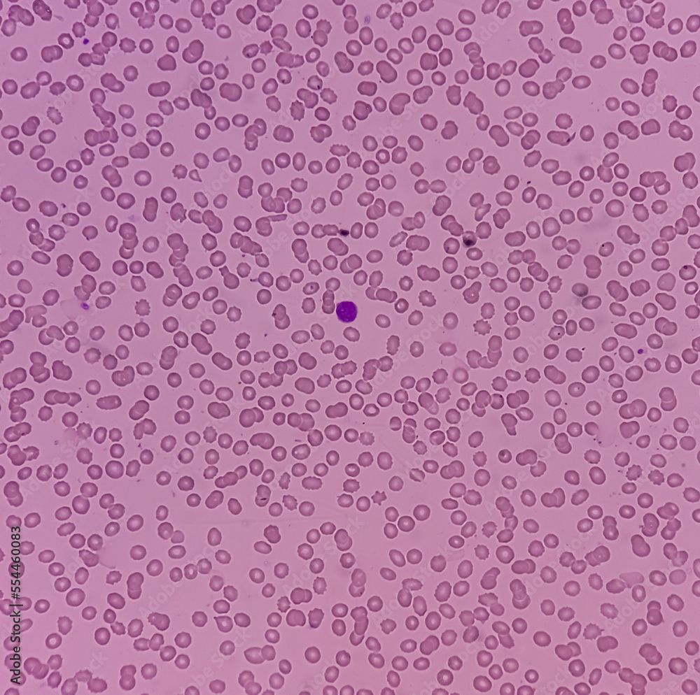 Acute promyelocytic leukemia(APL, APML). Blast cells, a type of blood ...