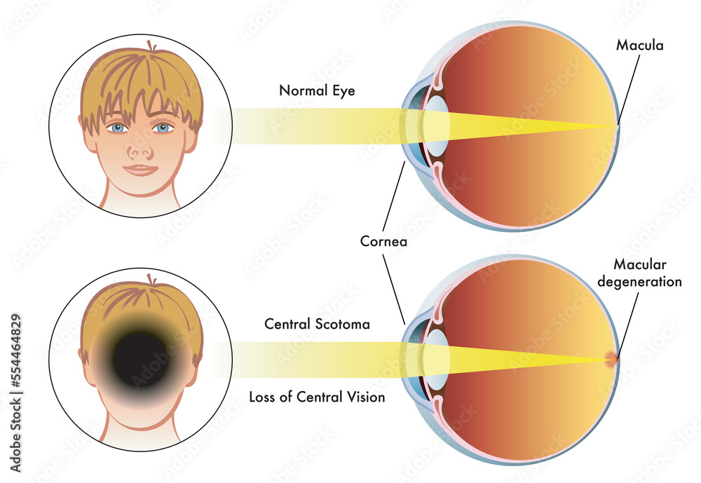 Medical illustration compare a human eye with central scotoma, with ...