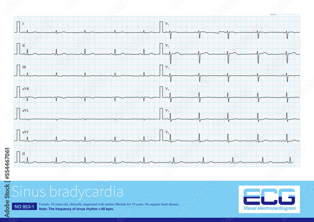 Sinus bradycardia refers to the frequency of impulses issued by the ...