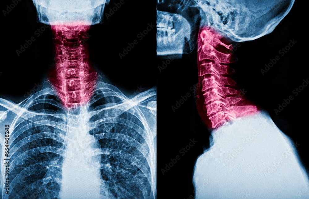 film x-ray skull lateral view and neck pain Stock Photo | Adobe Stock