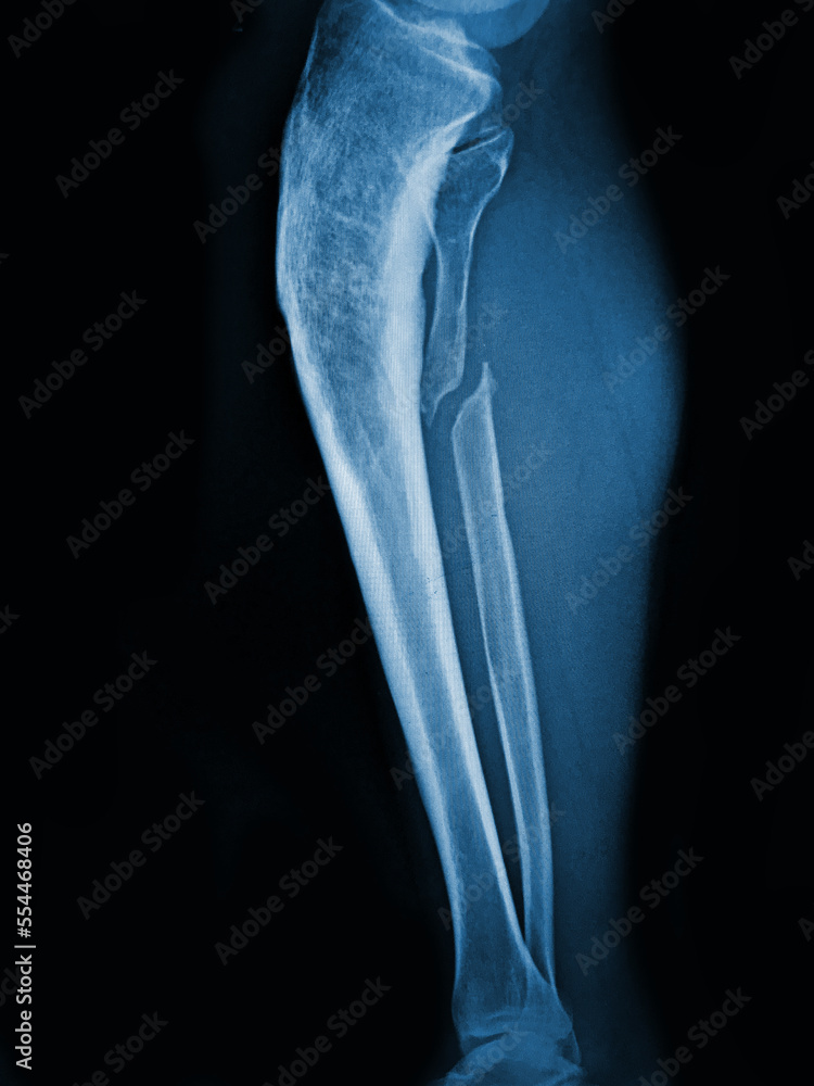 X-ray human fibula fracture Lateral view Stock Photo | Adobe Stock