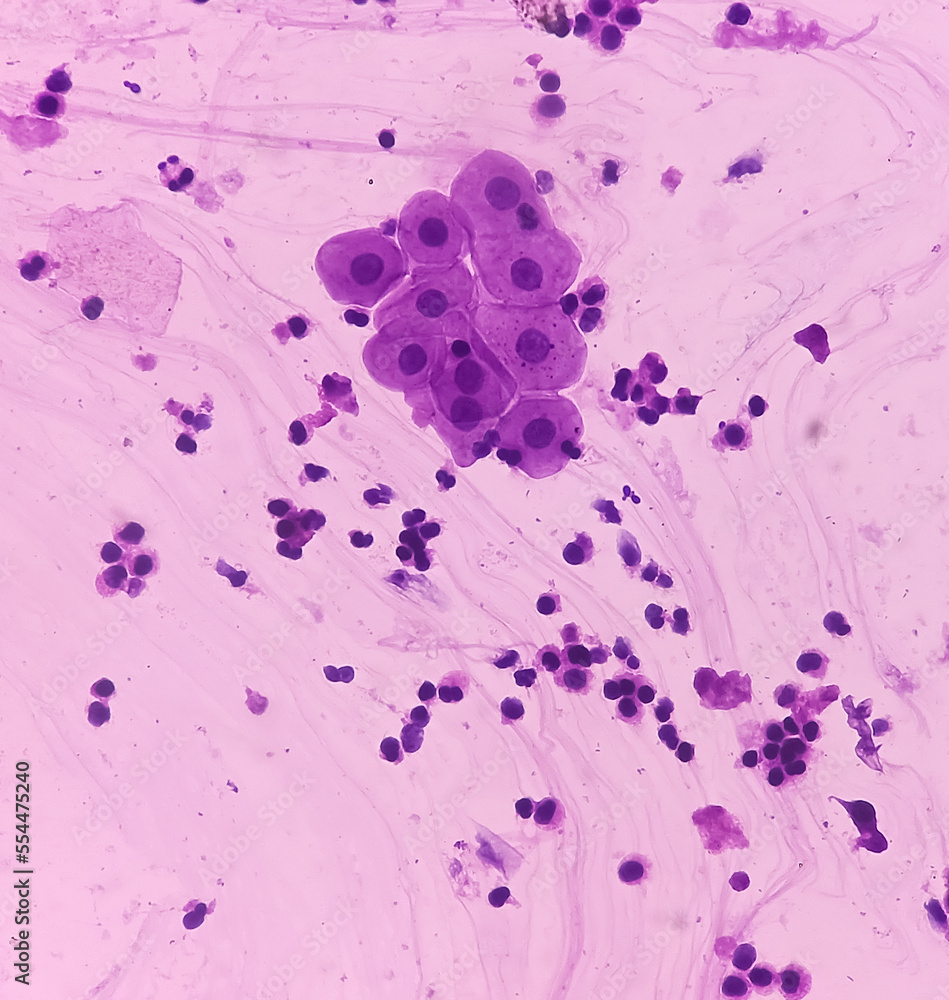 Photomicrograph of urine microscopy, urine cytology, Pap stain. Shows ...