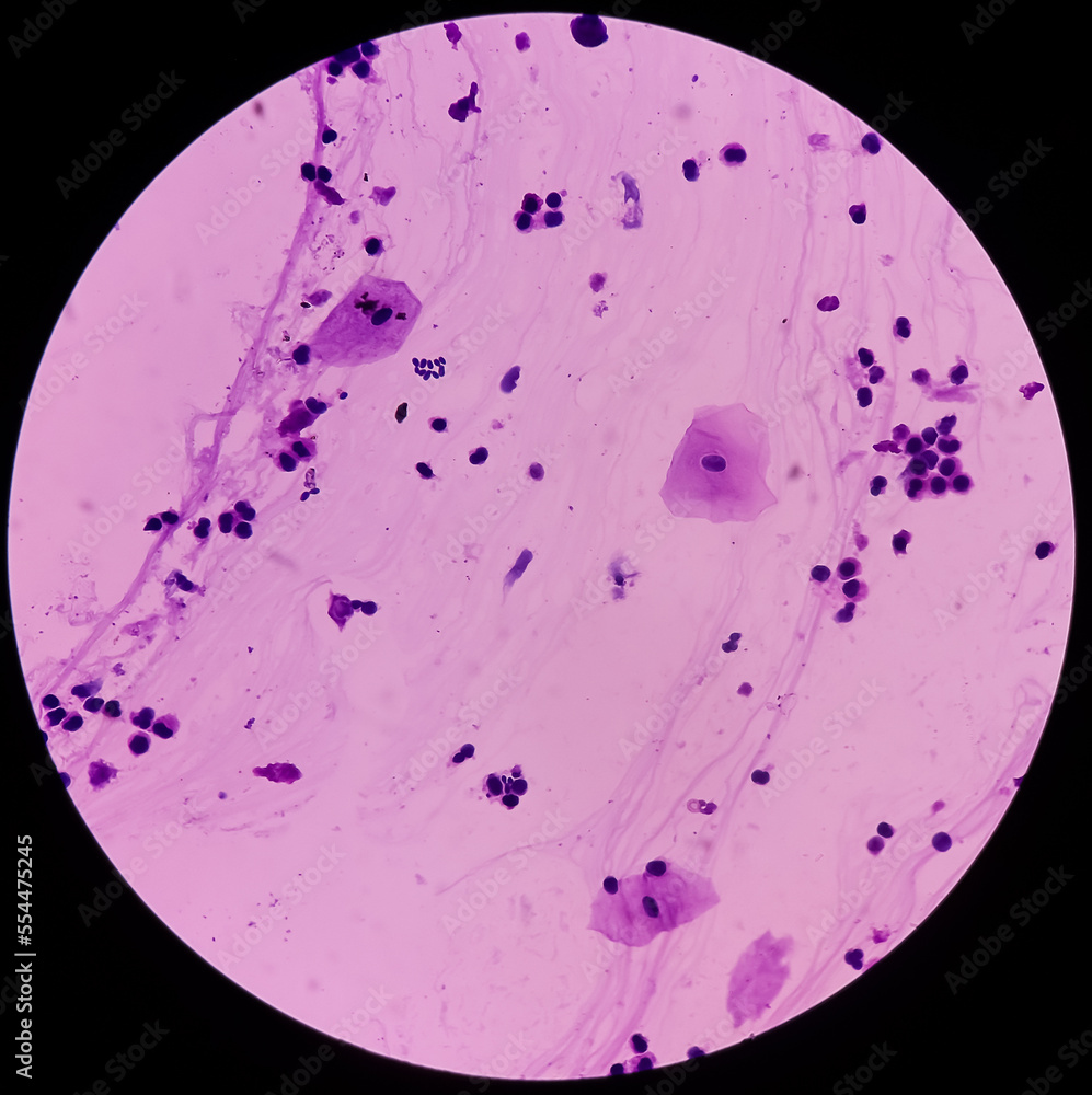 Photomicrograph of urine microscopy, urine cytology, Pap stain. Shows ...