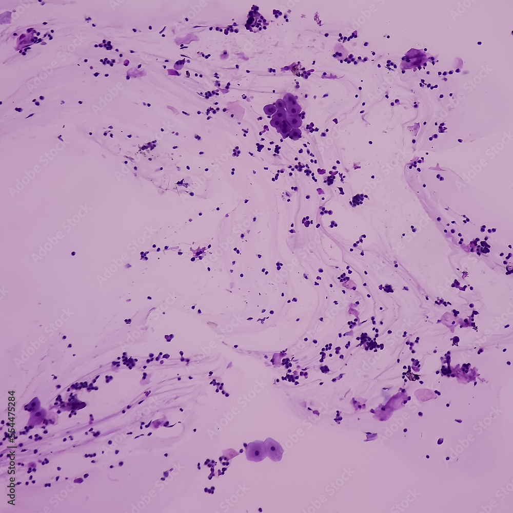 Photomicrograph of urine microscopy, urine cytology, Pap stain. Shows ...