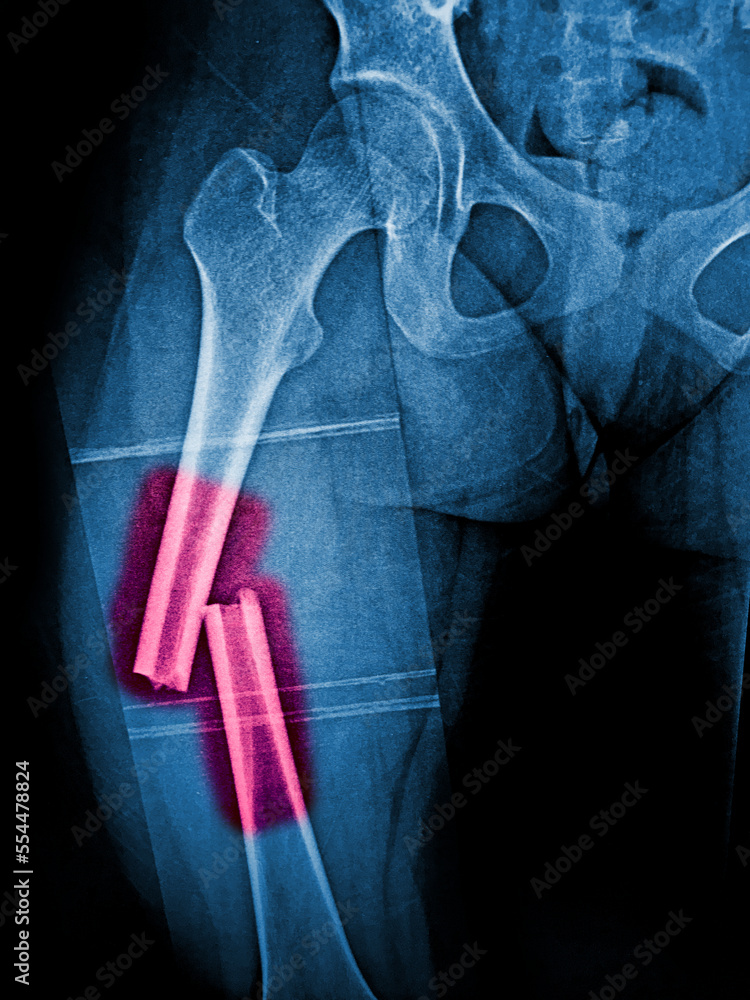 Film X-ray femur show complete fracture shaft of femur and displace ...
