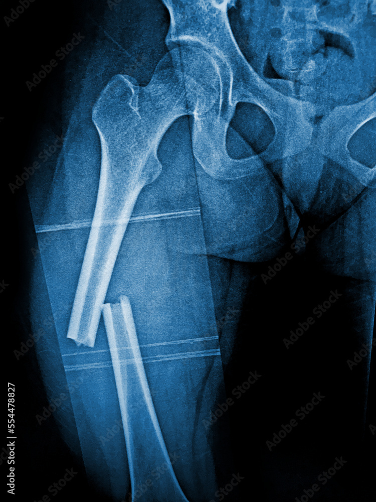 Film X-ray femur show complete fracture shaft of femur and displace ...