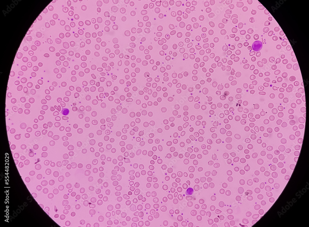 Foto de Congenital hemolytic anemias (CHAs). Anisocytosis anisochromia ...