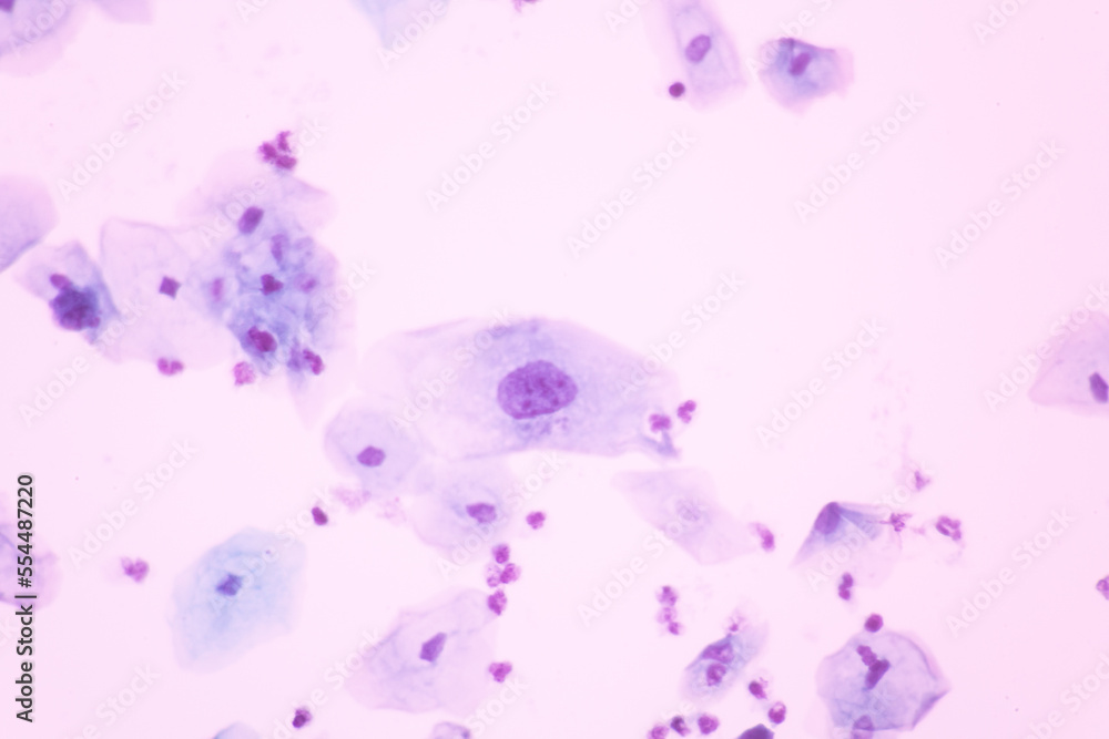 Iew In Microscopic Of Abnormal Human Cervix Cells Squamous Epithelium