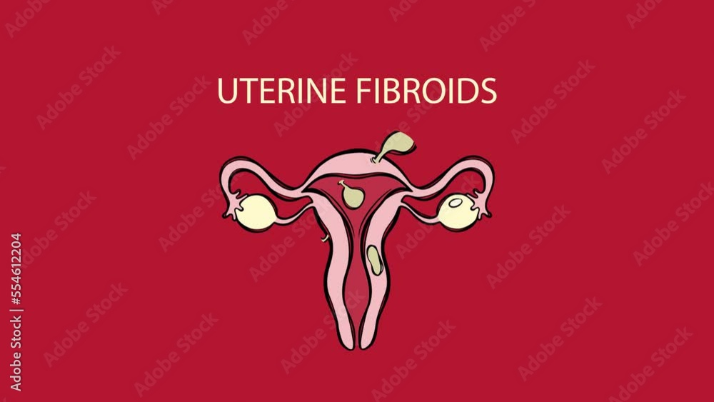 UTERINE FIBROIDS VIDEO Leiomyoma Benign Tumor Of The Smooth Muscles Of ...