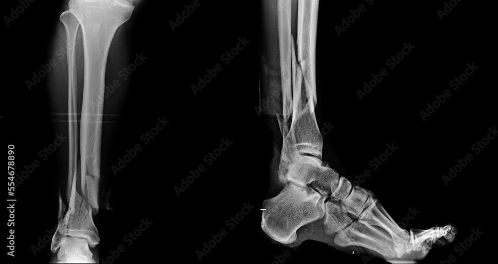 x-ray image of fracture leg bone . Stock Photo | Adobe Stock