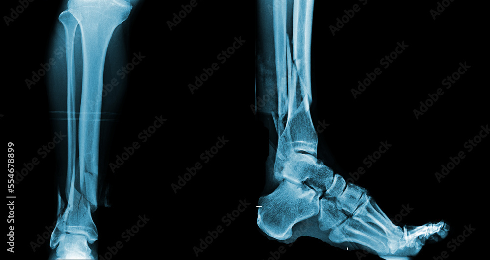 x-ray image of fracture leg bone . Stock Photo | Adobe Stock