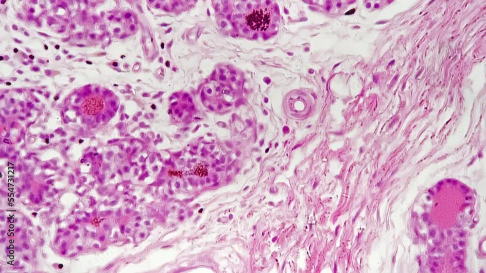 Stasis of mammary gland filmed under microscope 400x against bright ...