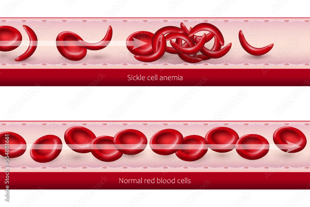 Comparing the blood flow of sickle cell anemia blood with normal red ...
