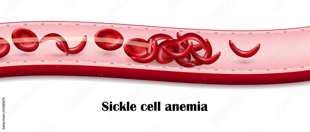 Sickle cell disease. Blood flow of sickle cell anemia. Stock Vector ...