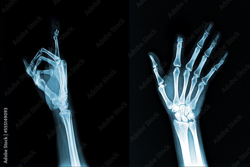 ( film x-ray index facture finger and hand ( facture is point a finger ...