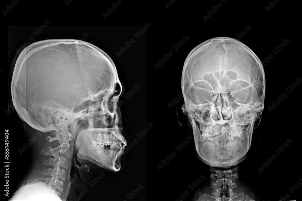 X-ray Lateral view skull and cervical spine . AP skull and cervical ...