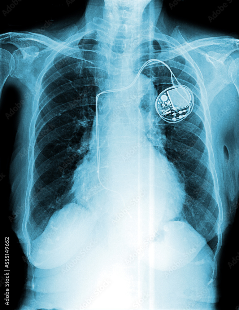 Film chest x-ray show pacemaker implantation in red area Stock Photo ...