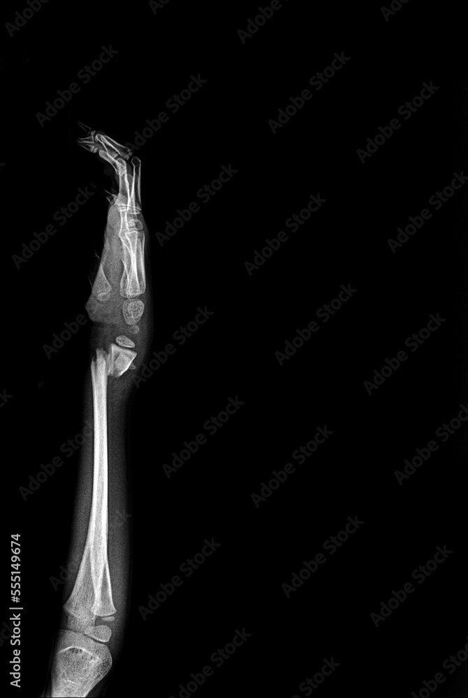 film X-ray fracture forearm Stock Photo | Adobe Stock