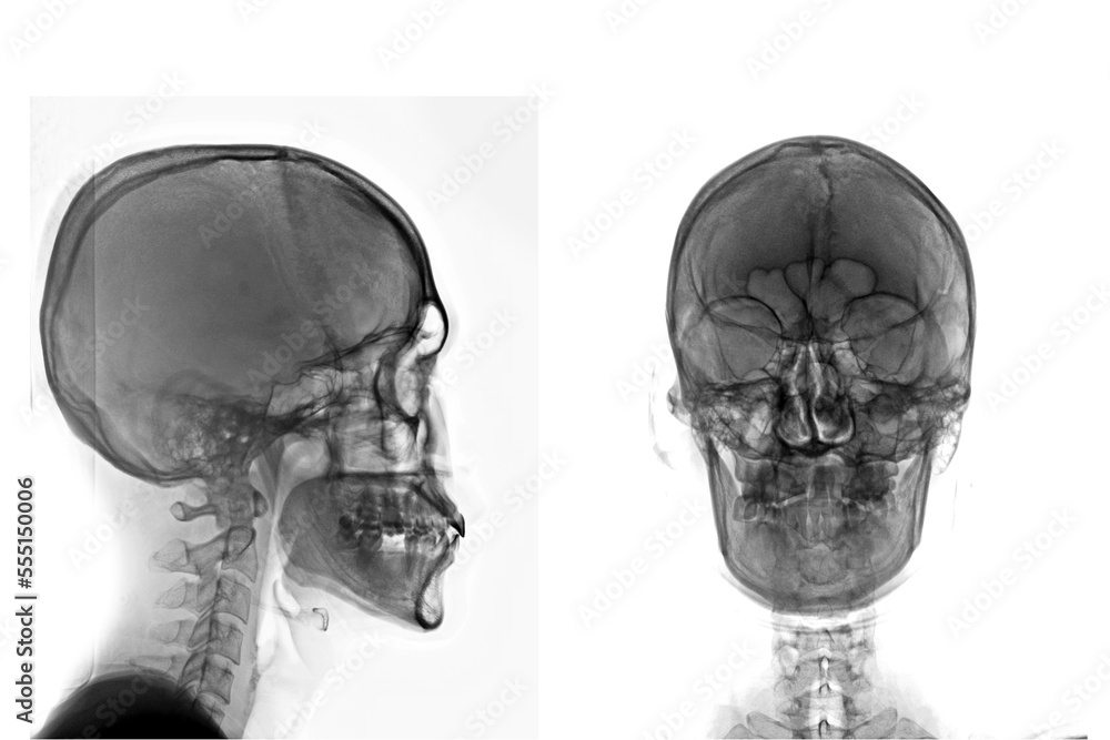 X-ray Lateral view skull and cervical spine . AP skull and cervical ...
