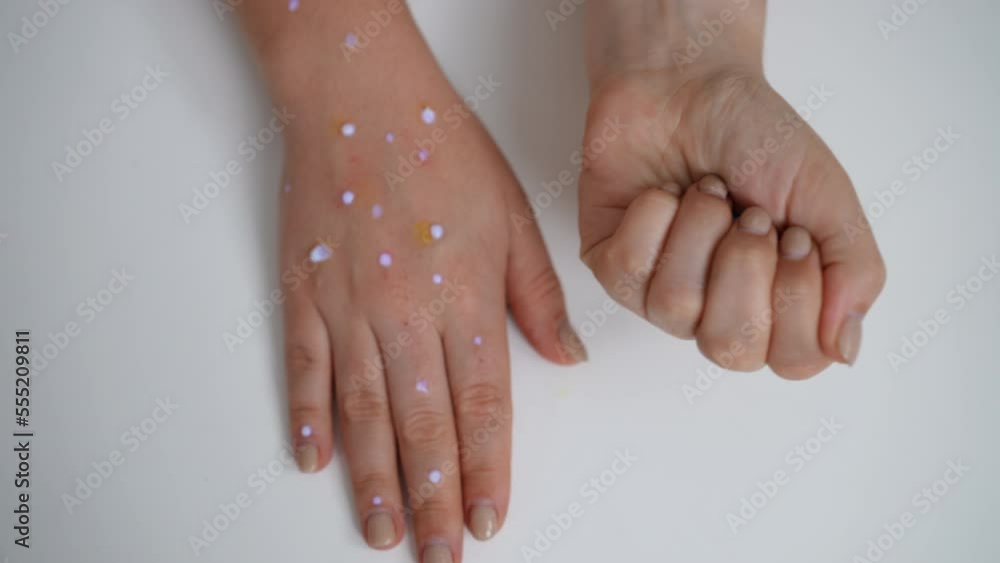 Close-up top view female hand with monkey pox rash and fist appearing ...