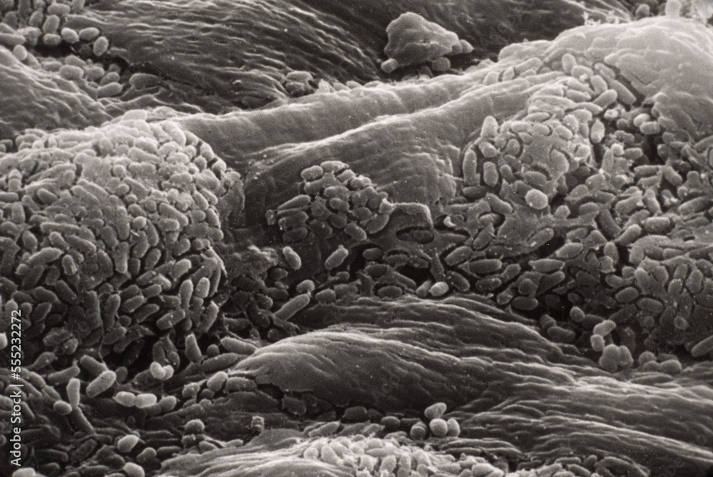 The underside of a person's toenail under high magnification, showing a ...