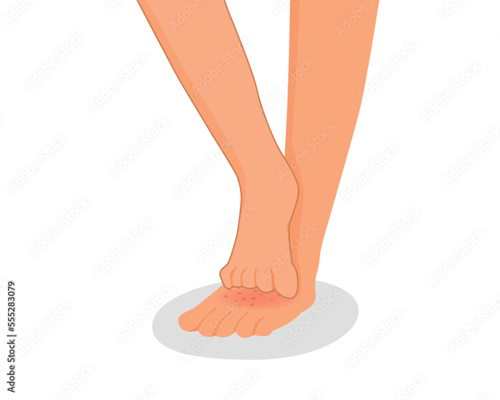 human leg scratching itchy foot with rash dry skin because of allergic ...