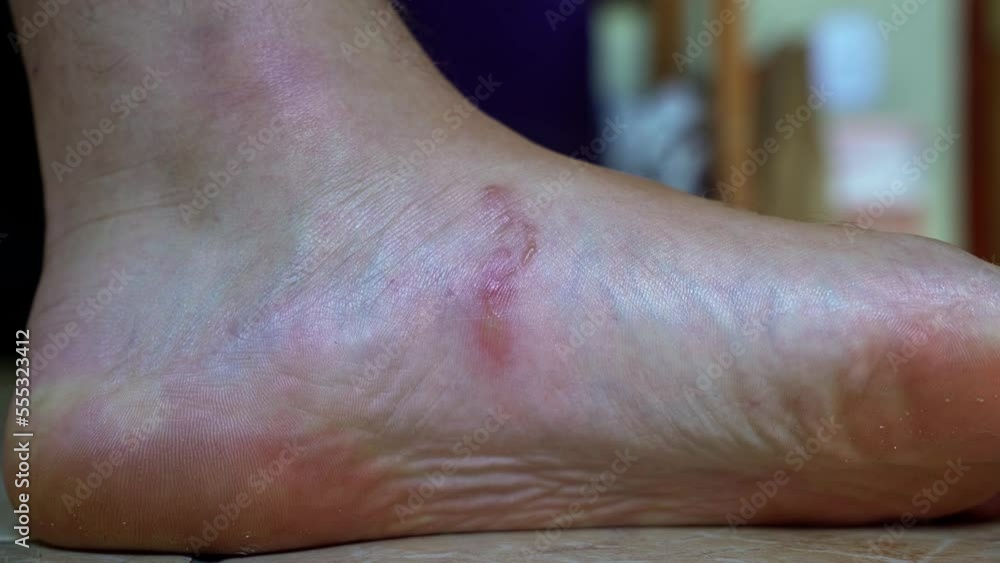 Hookworm infected foot of a young male stepping barefoot into frame ...
